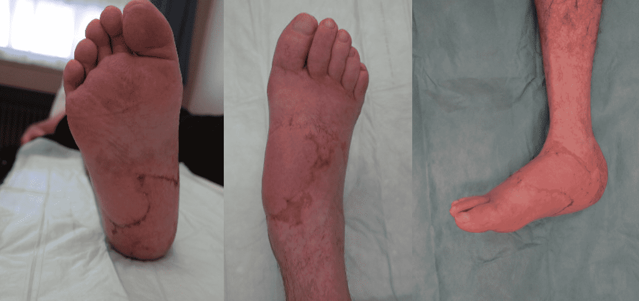 Case 2 – 2025: Reconstruction of an extensive foot defect using a ...